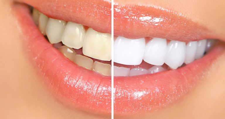 Tooth Whitening - Orange Tree Dental